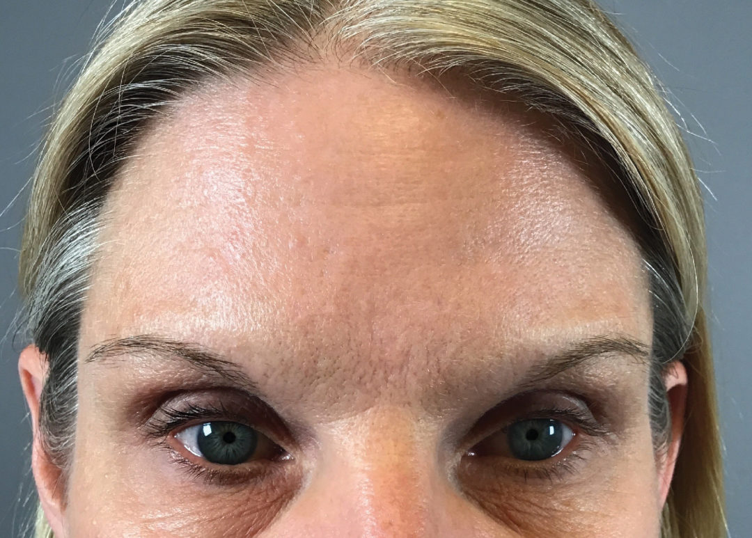 Post Treatment Cream | Custom Post Procedure Skincare