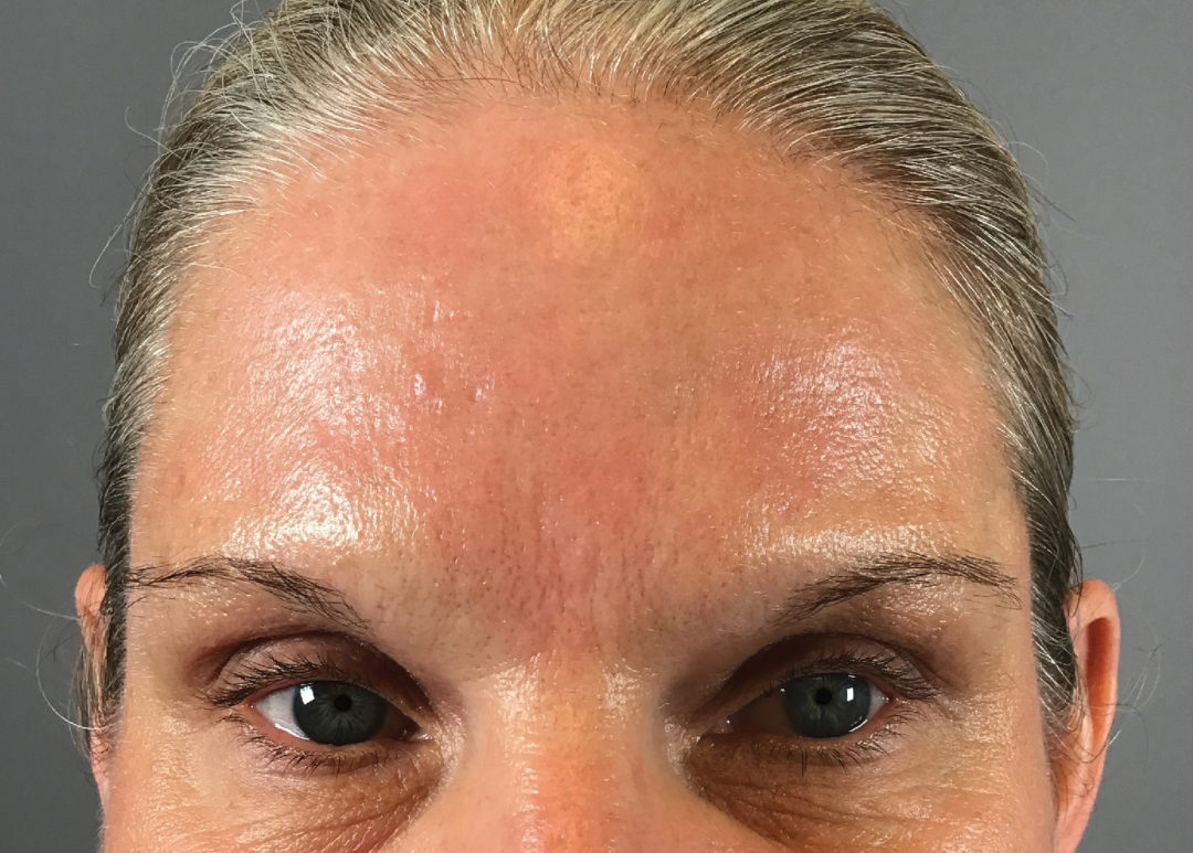 Post Treatment Cream | Custom Post Procedure Skincare