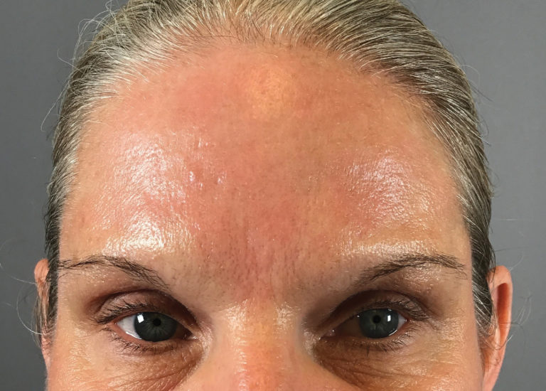 Post Treatment Cream | Custom Post Procedure Skincare